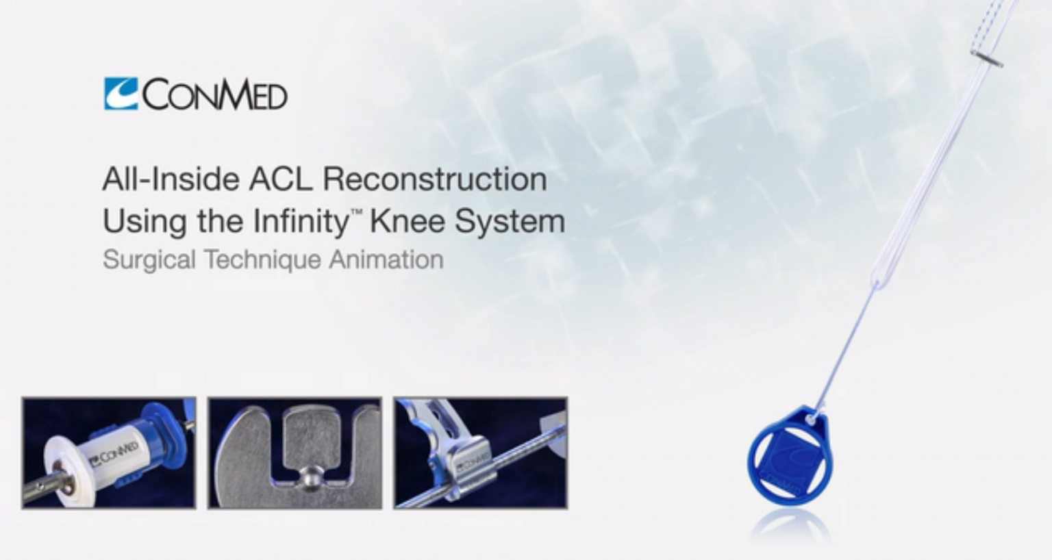 All-inside Acl Reconstruction Surgical Technique-orthopaedic Solutions ...