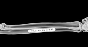Forearm Fracture Solutions Hand Wrist – Fixation Products - Medhold Medical