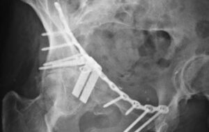 Pelvic Plating System Orthopaedic Solutions Fixation Products - Medhold ...