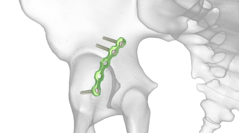 Pelvic Plating System Orthopaedic Solutions Fixation Products - Medhold ...