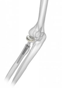 Anatomic Radial Head Solutions – Radial Head Replacement System ...