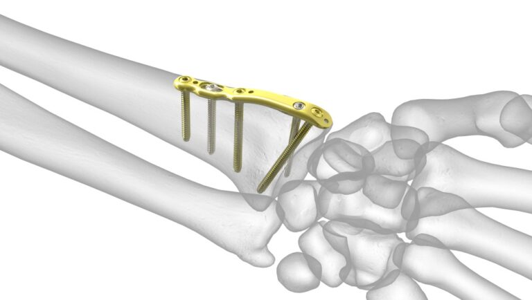 Hand & Wrist Acu-Loc 2 Wrist Plating System Acumed Distal Radius ...