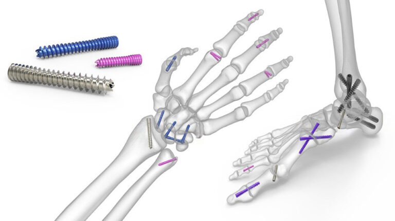 Acutrak 2 Headless Compression Screw System - Medhold Medical