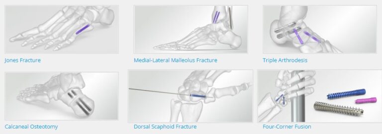 Acutrak 2 Headless Compression Screw System - Medhold Medical