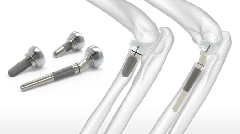 Anatomic Radial Head Solutions – Radial Head Replacement System ...