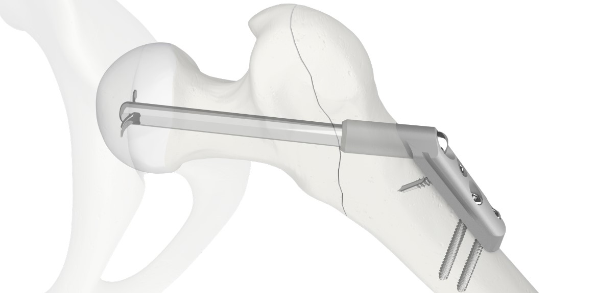 Hansson Twin Hook® With Twin Hook Locking Plate DHS-CHS- Femur Neck ...