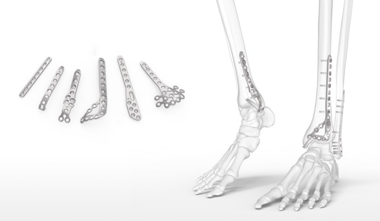 OsteoMed ExtremiLock Ankle Plating System – Osteomed Ankle Fracture ...