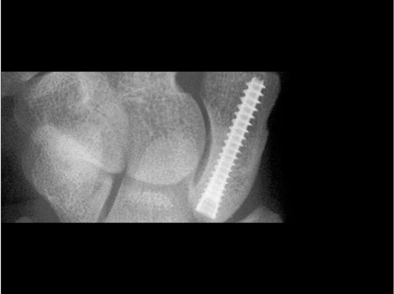 Acutrak 2 Headless Compression Screw System - Medhold Medical