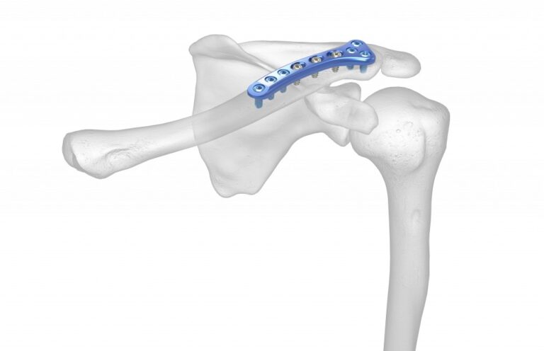 Clavicle Plating System - Medhold Medical