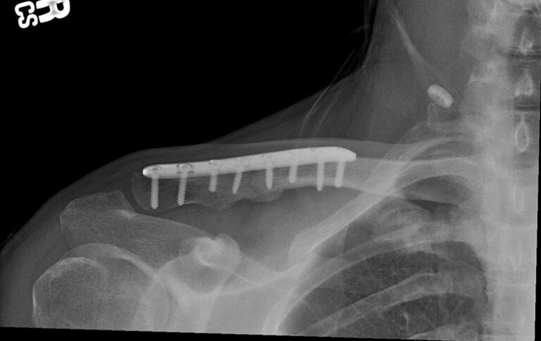 Clavicle Plating System – Fixation Products - Medhold Medical