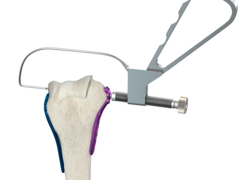Elbow Plating System- Elbow Plating Fixation Products - Medhold Medical