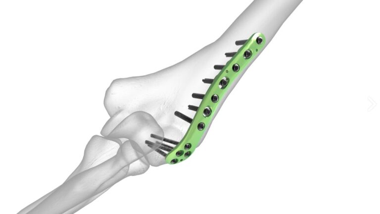 Elbow Plating System- Elbow Plating Fixation Products - Medhold Medical
