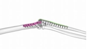 Elbow Plating System- Elbow Plating Fixation Products - Medhold Medical