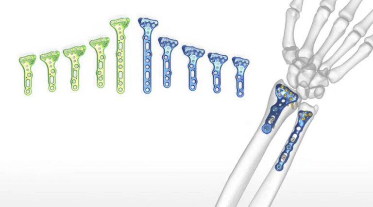 Hand & Wrist Acu-Loc Wrist Plating System Acumed Distal Radius Fracture ...