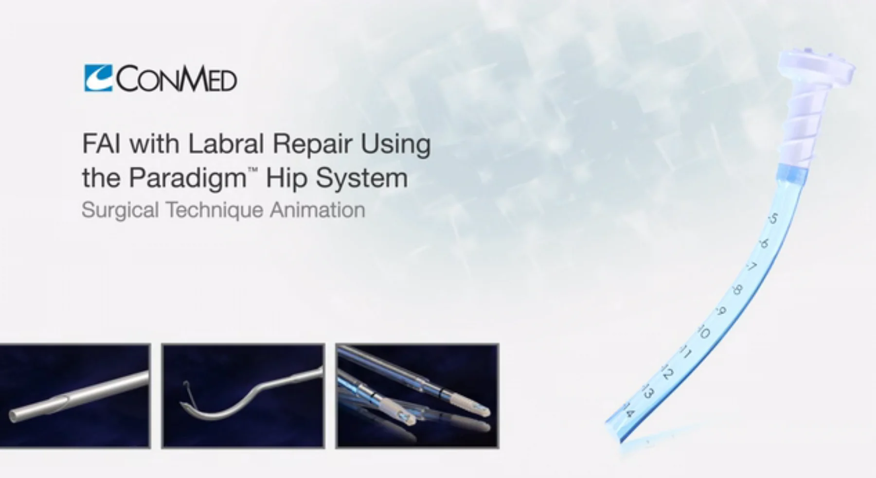 Treating FAI with a Labral Tear Using the Paradigm™ Hip System and ...